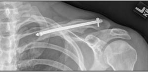 Clavicle Fracture: Symptoms, Diagnosis & Treatment