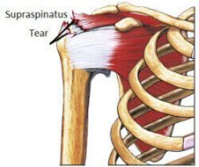 Upper Arm Pain: Causes, Diagnosis & Treatment