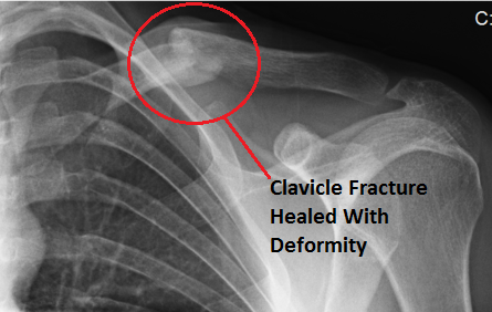 Clavicle Fracture: Symptoms, Diagnosis & Treatment