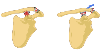 Collar Bone Pain: Common Causes & Symptoms