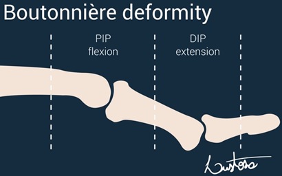 Boutonniere Deformity Finger: Causes, Symptoms & Treatment