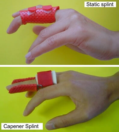 Boutonniere Deformity Finger: Causes, Symptoms & Treatment