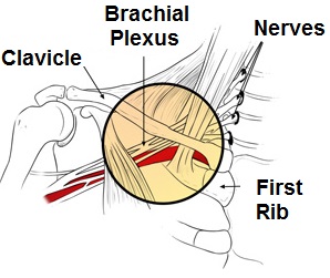Brachial Neuritis aka Parsonage Turner Syndrome