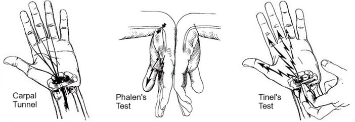 Carpal Tunnel Syndrome (Wrist): Symptoms, Causes & Treatment