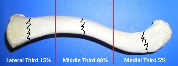 Clavicle Fracture: Symptoms, Diagnosis & Treatment