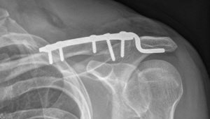 Clavicle Fracture: Symptoms, Diagnosis & Treatment
