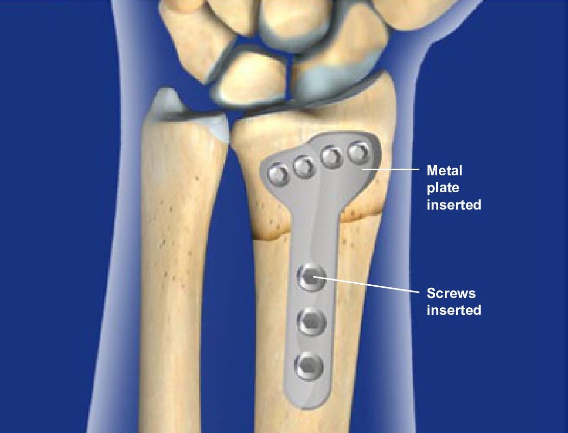 Distal Radius Fracture Causes And Treatment For Wrist Fractures