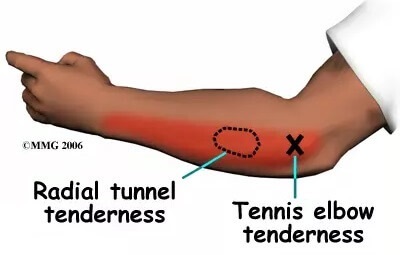 Pain In The Forearm Causes Symptoms Treatment Of Forearm Pain