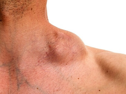 Lump Or Bump On Top Of Shoulder: Causes & Treatment Lump Or Bump On Top Of Shoulder: Causes & Treatment