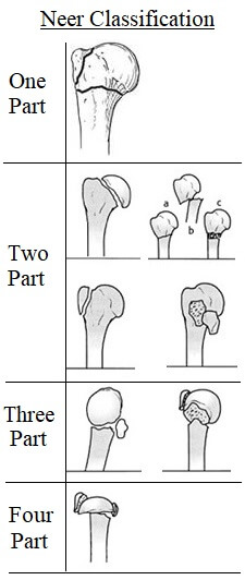 Neer Classification Proximal Humerus Fracture Neer Classification Proximal Humerus Fracture