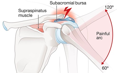 Shoulder and upper arm pain store
