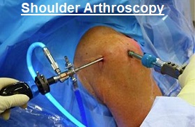 Frozen Shoulder Treatment, Symptoms & Prevention