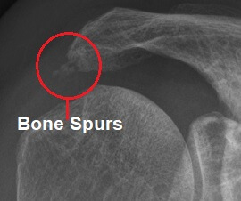 Subacromial Decompression Surgery For Shoulder Impingement