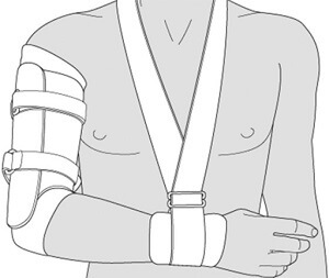 Humerus Fracture: Causes, Symptoms & Treatment