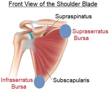 Scapulothoracic Bursitis aka Snapping Scapula Syndrome