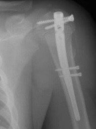 Proximal Humerus Fracture: Causes, Treatment & Recovery